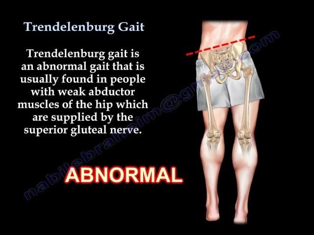 Understanding Trendelenburg Gait: Causes, Symptoms, and Implications ...