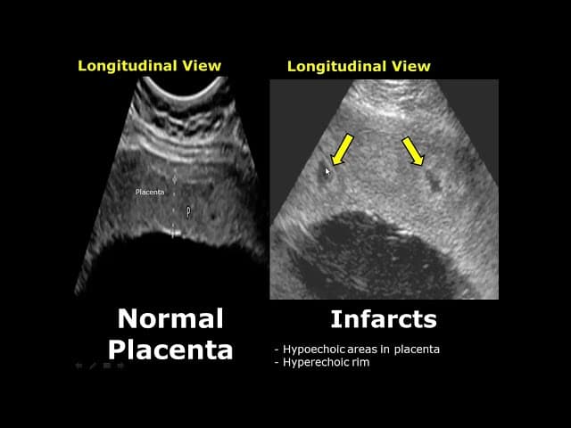 Understanding Placenta Ultrasound: Normal vs Abnormal Appearances ...