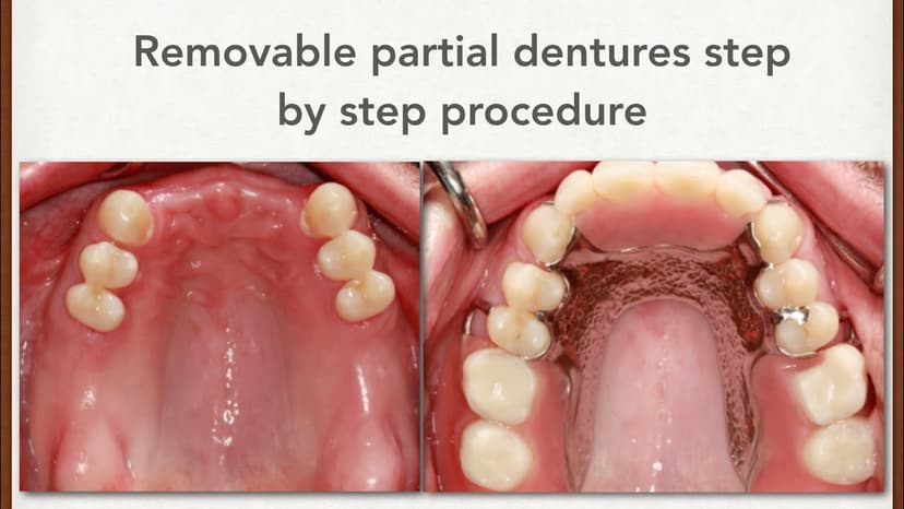 A Comprehensive Guide to the Step-by-Step Procedure for Removable ...