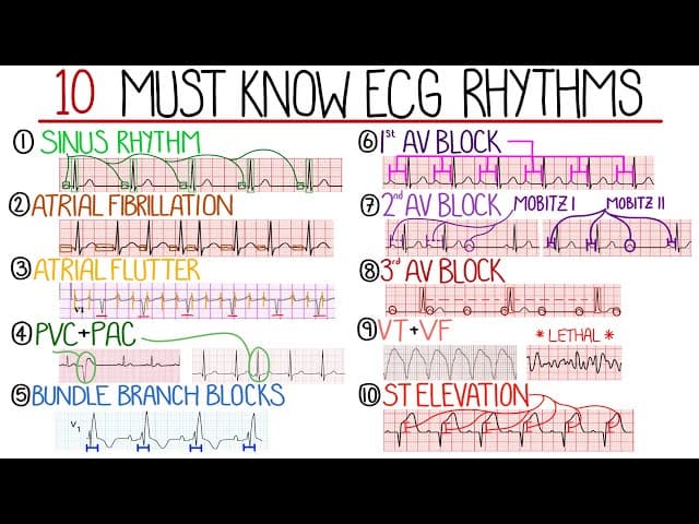 Understanding Common ECG Patterns: A Comprehensive Guide | Galaxy.ai